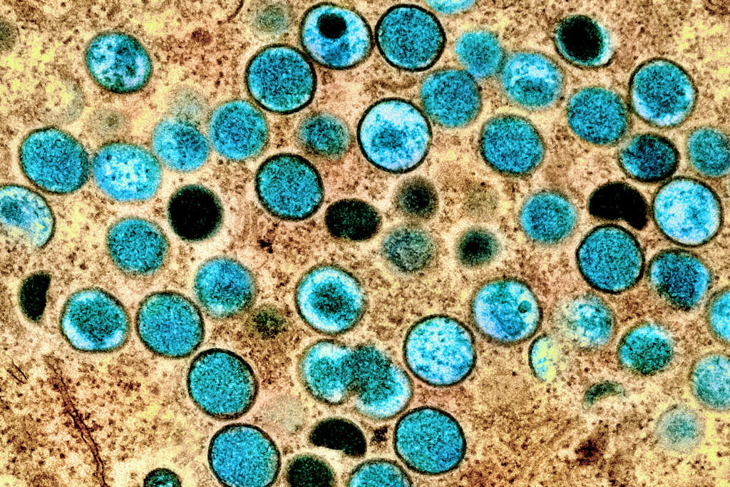 Variole du singe : 2e cas à La Réunion